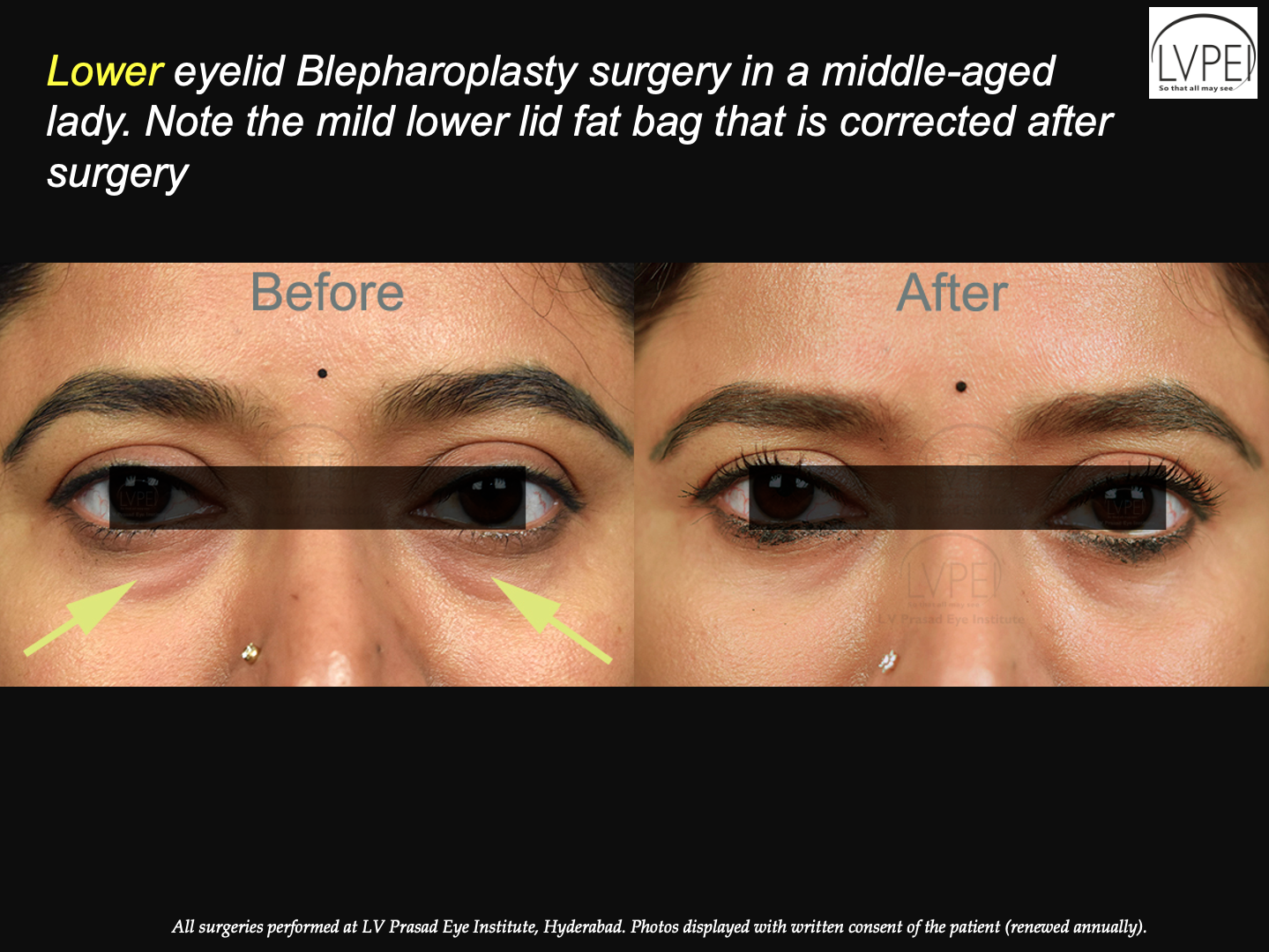 Eyelid Bags and Skin folds